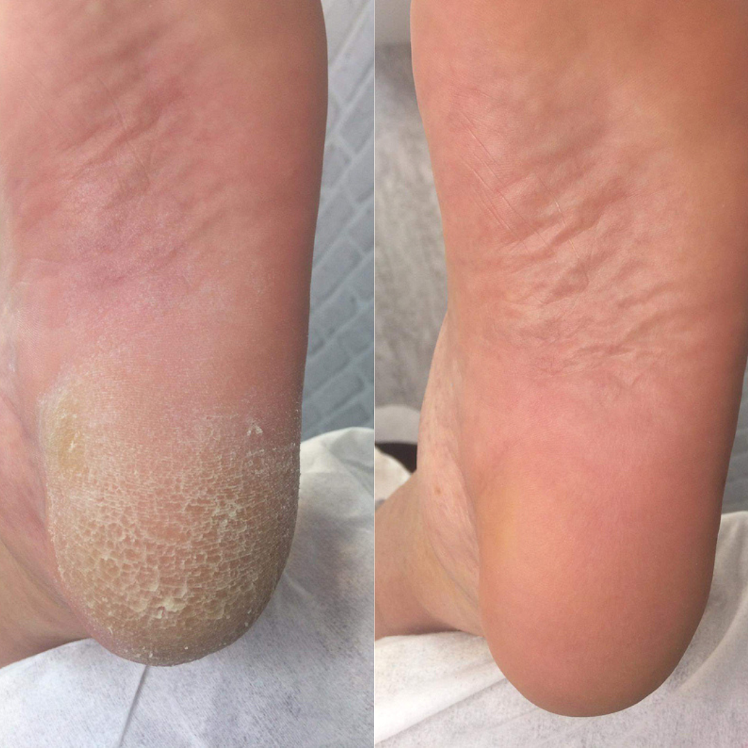 Skarpetki GlowFeet – domowy sekret gładkich stóp – Enentis